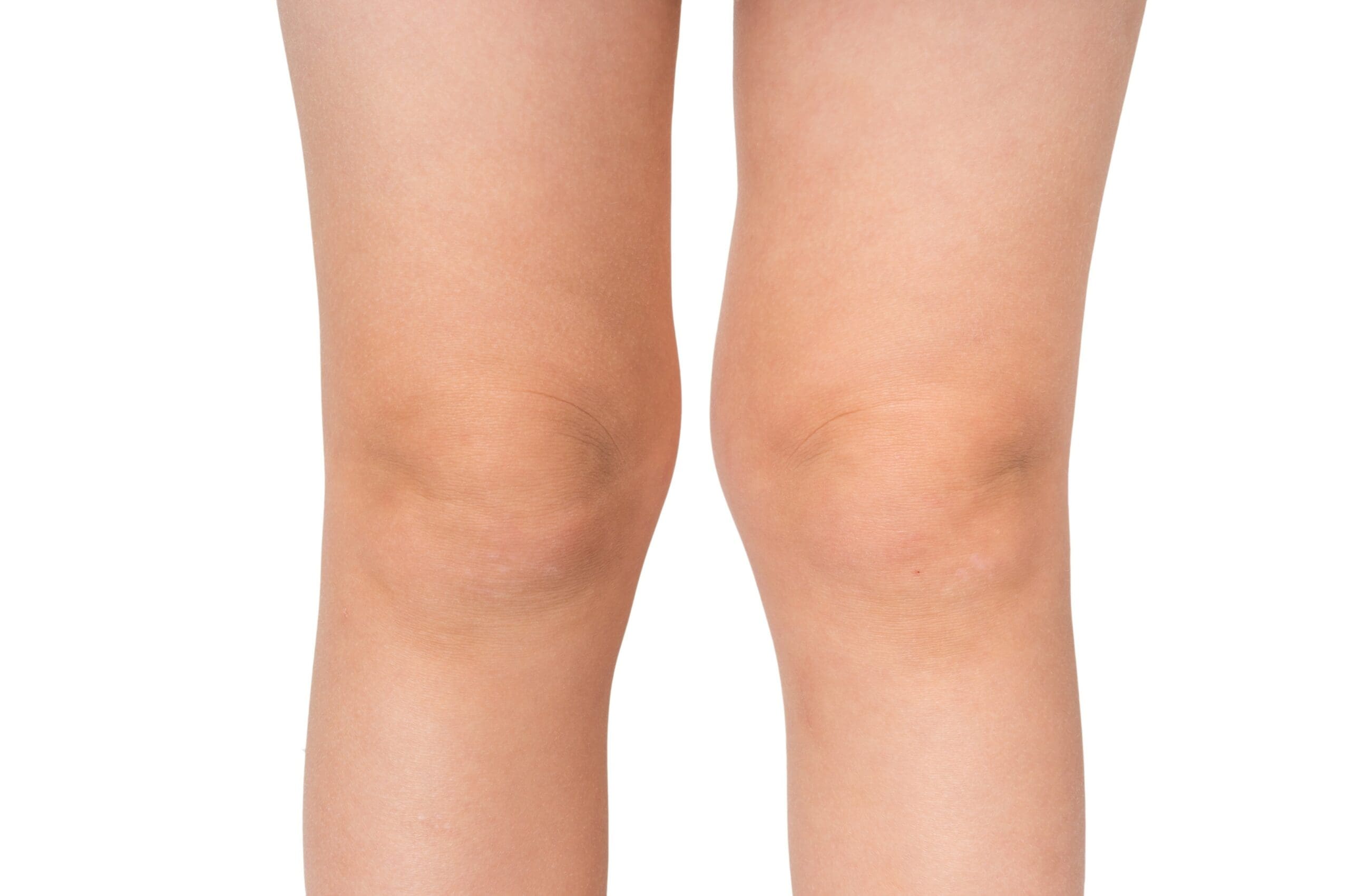Knock Knees MyDr au