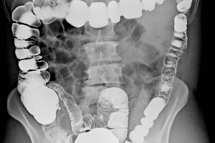 Barium Enema Lower Bowel Examination MyDr au