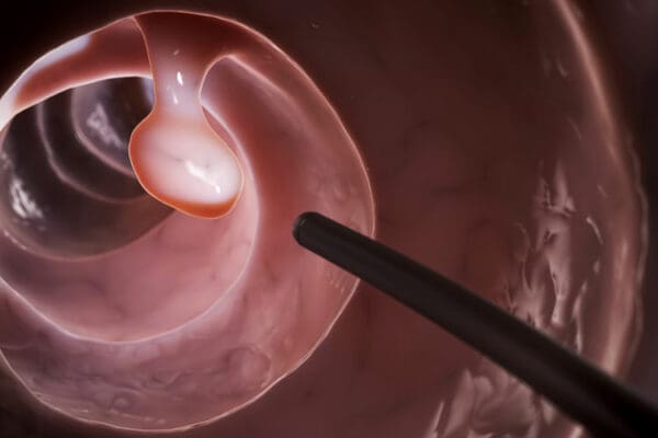 Colonoscopy: examination of the colon - myDr.com.au