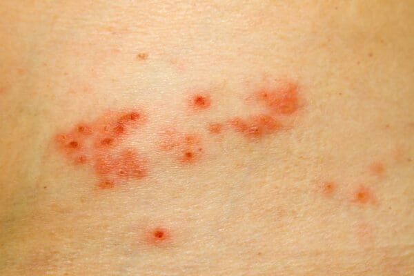 Shingles - myDr.com.au
