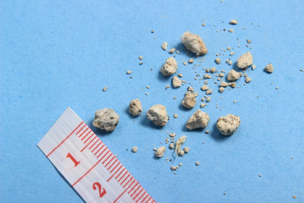 Kidney stones - symptoms, causes and treatment - MyDr.com.au