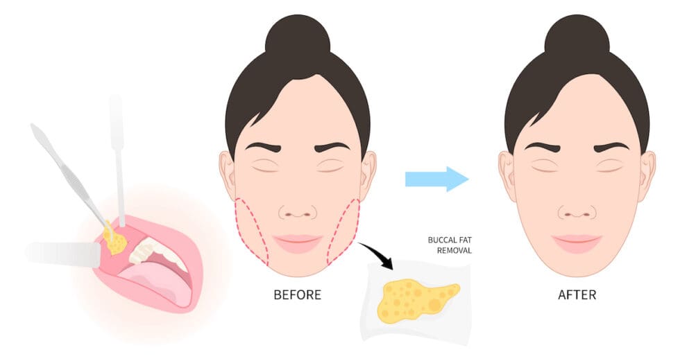 Buccal fat removal - your questions answered - MyDr.com.au